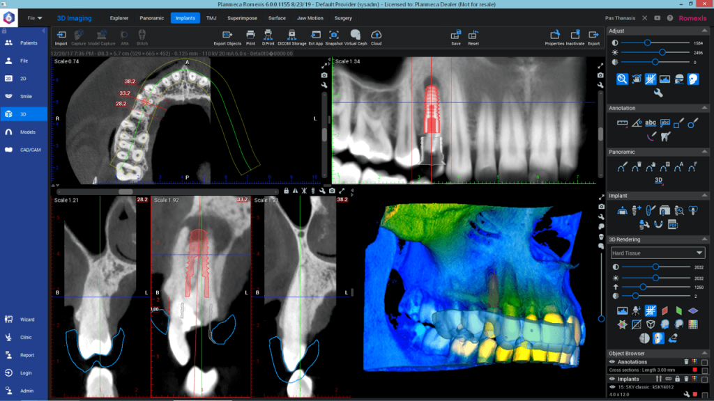 Virtual Planing & Guided Implant Placement - Manolakis Dental Clinic
